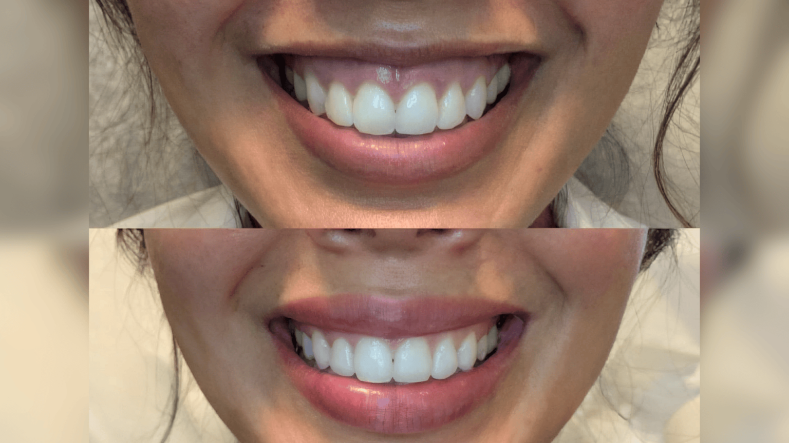 Lip Flip: Before and After with Procedure Explained - Rumbie
