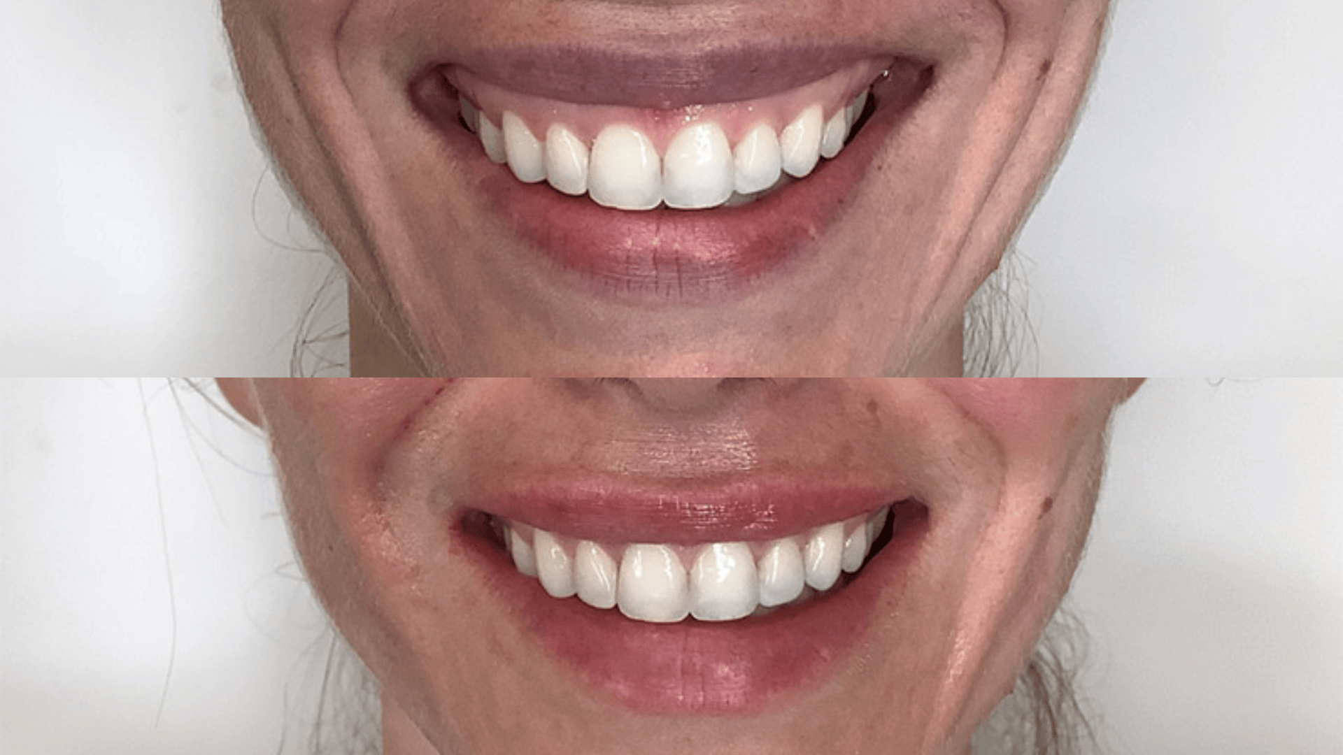 Lip Flip: Before and After with Procedure Explained - Rumbie