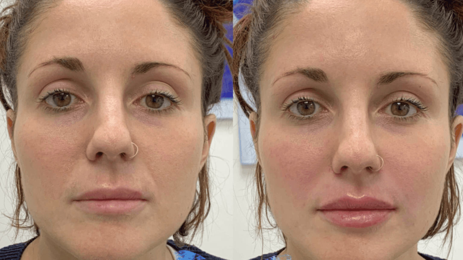 Lip Flip: Before and After with Procedure Explained - Rumbie