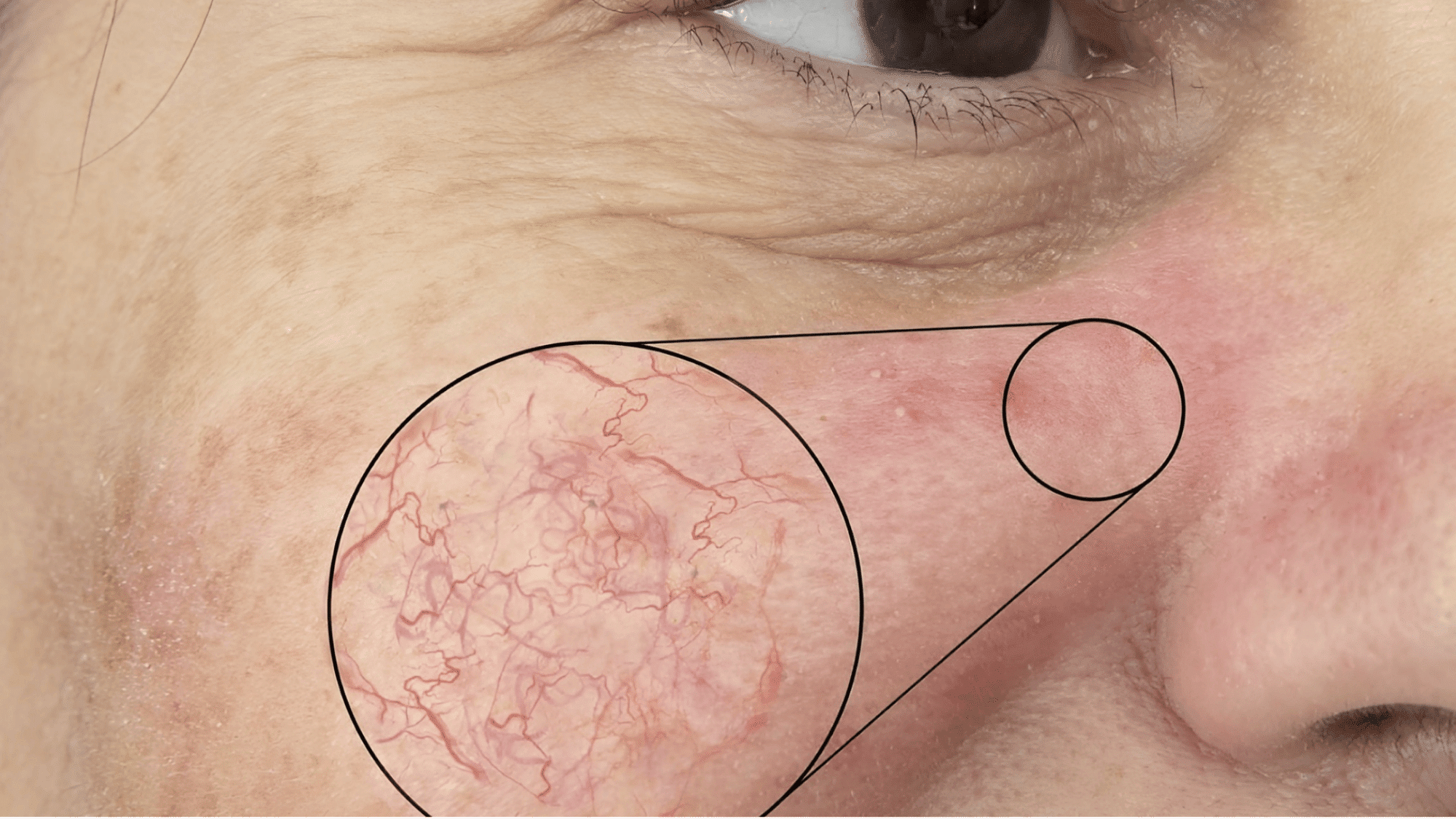 Broken Capillaries on Face: Causes & Fixes - Rumbie