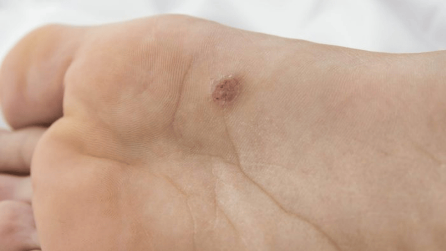 Bottom of Feet Dark Spots: What They Mean & Treatment - Rumbie