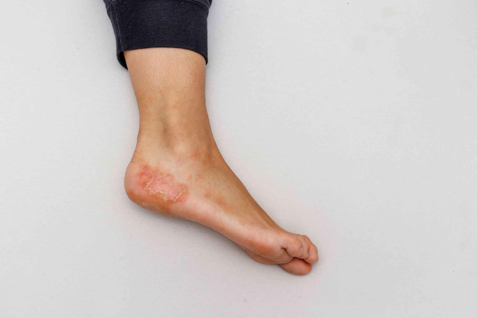 Bottom of Feet Dark Spots: What They Mean & Treatment - Rumbie