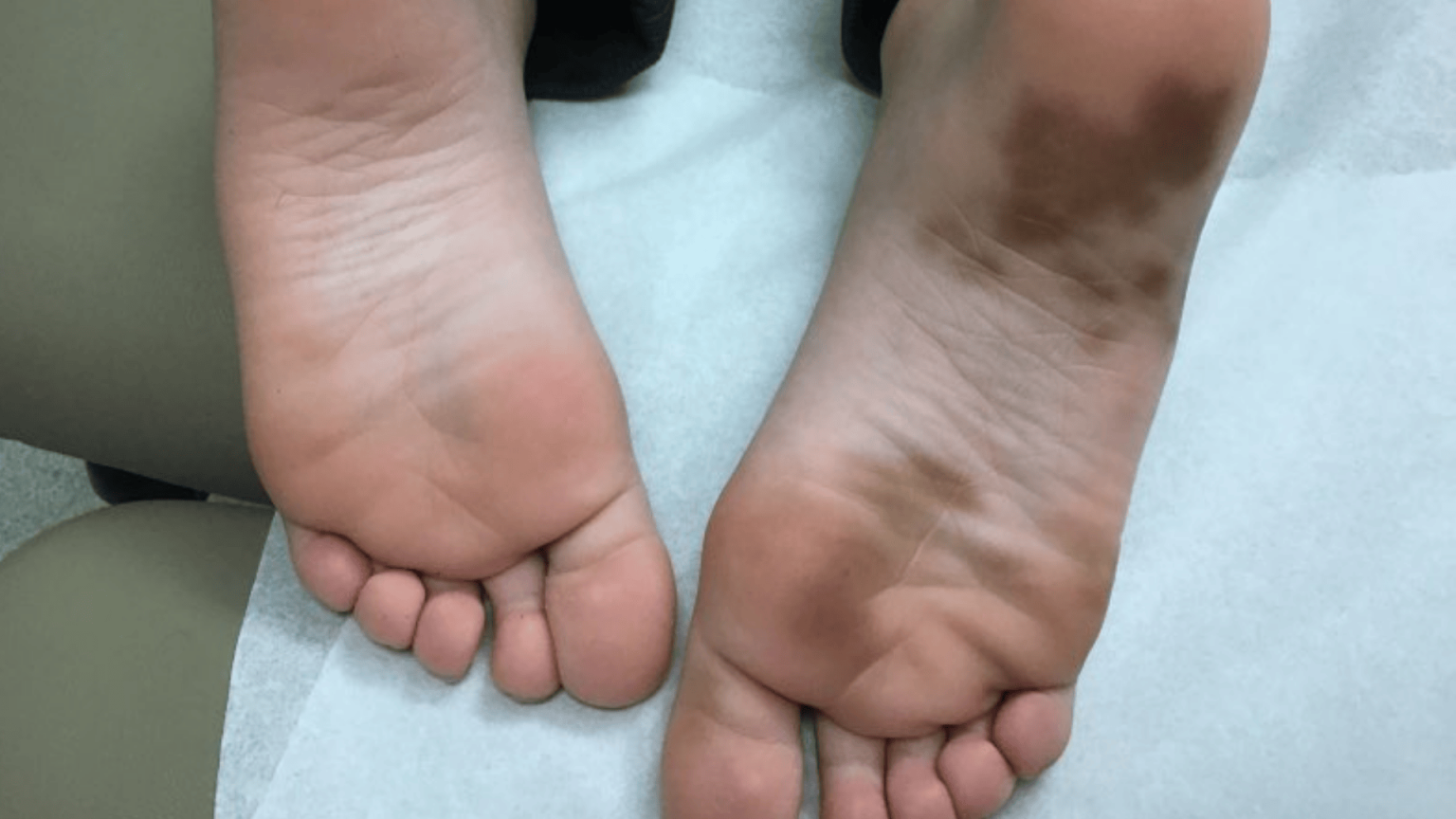 Bottom of Feet Dark Spots: What They Mean & Treatment - Rumbie