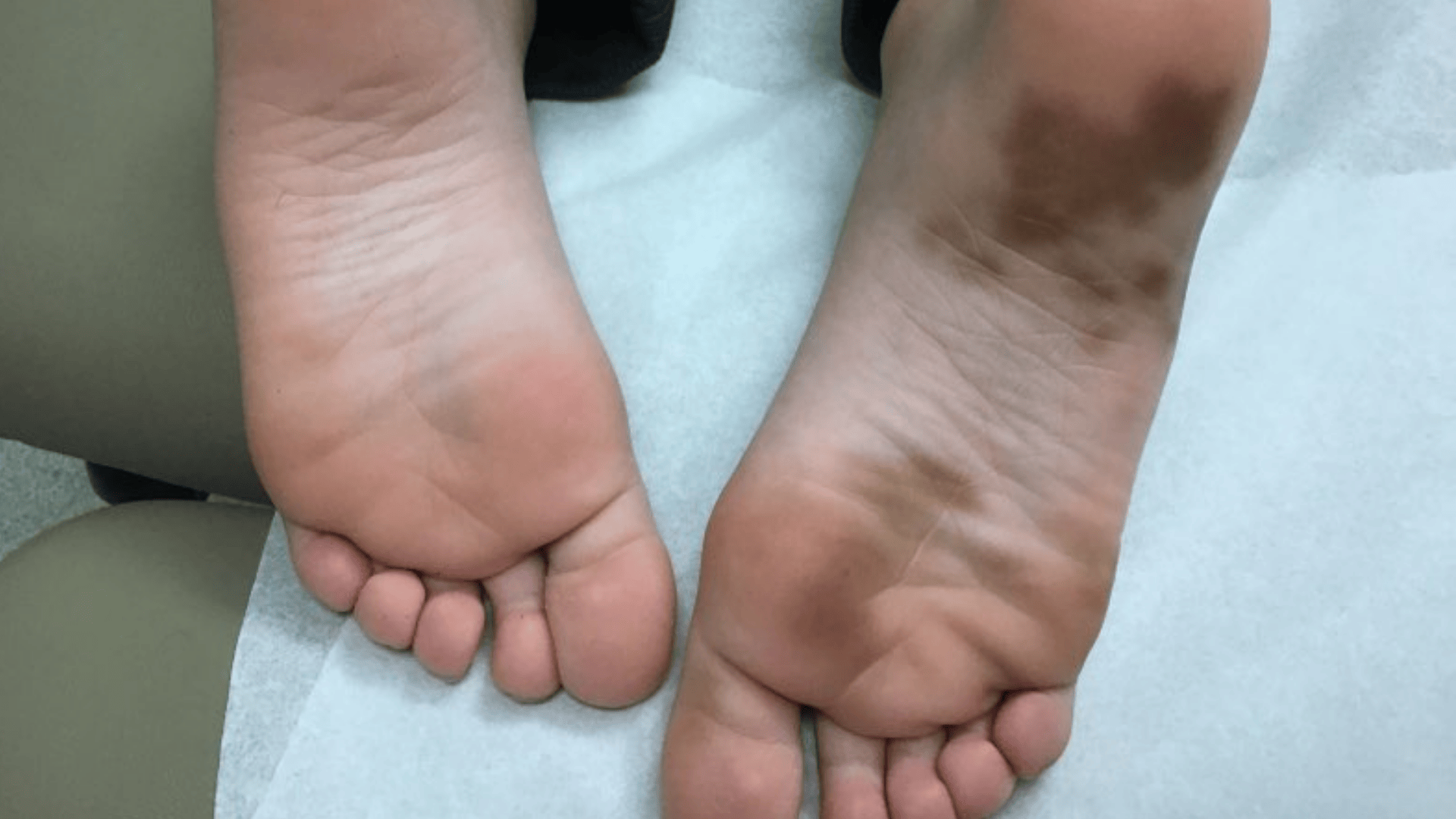 Bottom of Feet Dark Spots: What They Mean & Treatment - Rumbie