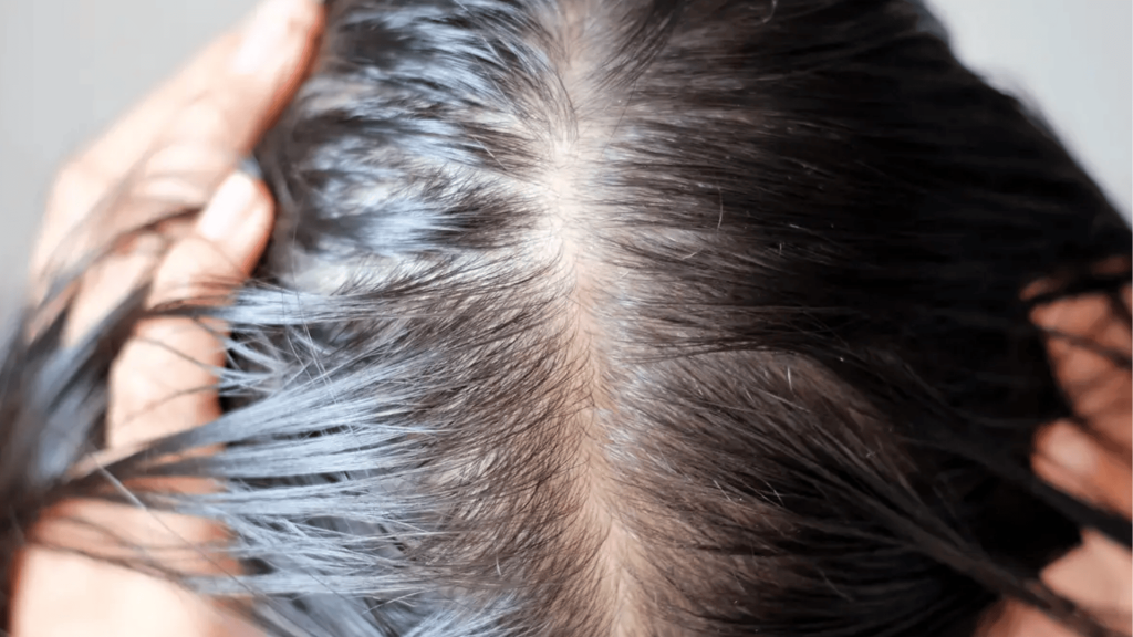 PCOS Hair Loss: Why It Happens and How to Fight Back - Rumbie